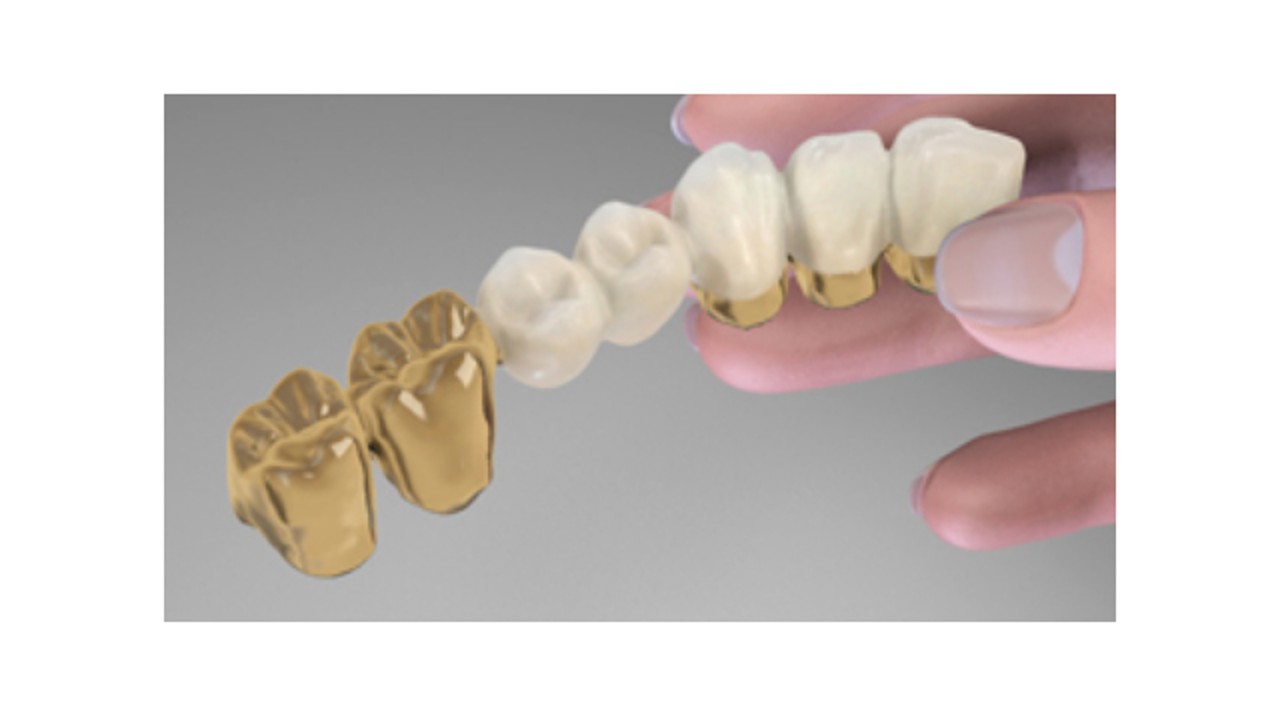 Tecnica per corone e ponti
