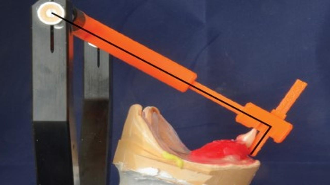 L'importanza dei contatti dentali nella protesi mobile